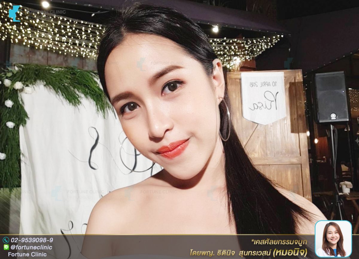 UPDATE 1ปีกว่าเคสหมอนิจ เนียน รับรูปหน้า (จมูก) - Fortune Clinic
