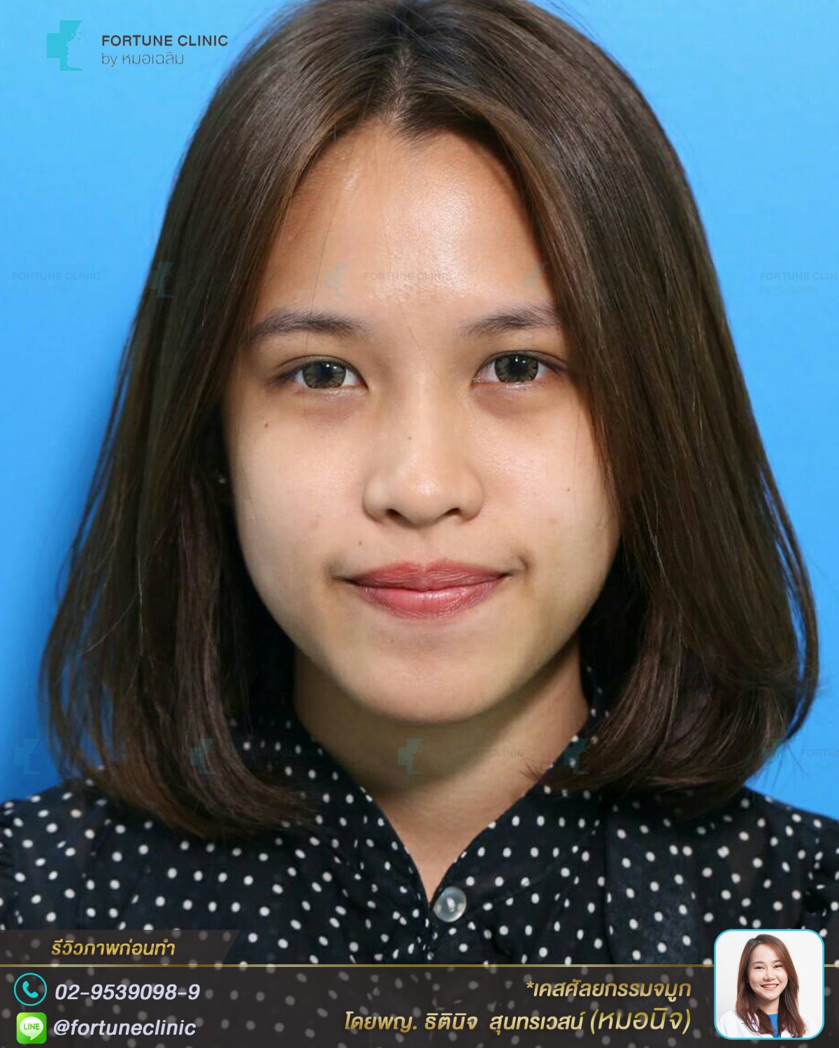 UPDATE 1ปีกว่าเคสหมอนิจ เนียน รับรูปหน้า (จมูก) - Fortune Clinic
