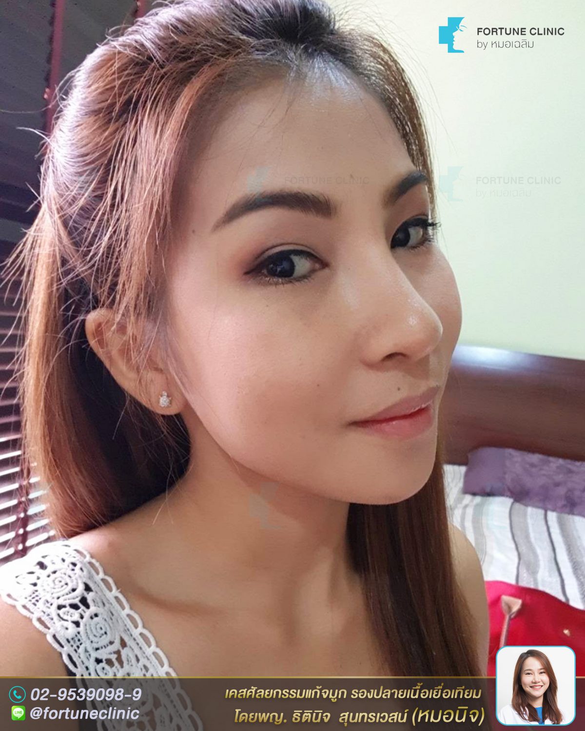 จากปลายบางใกล้ทะลุ มาเป็น ทรงโด่ง ปลายพุ่ง หน้าเรียวเล็กลง (จมูก) - Fortune Clinic