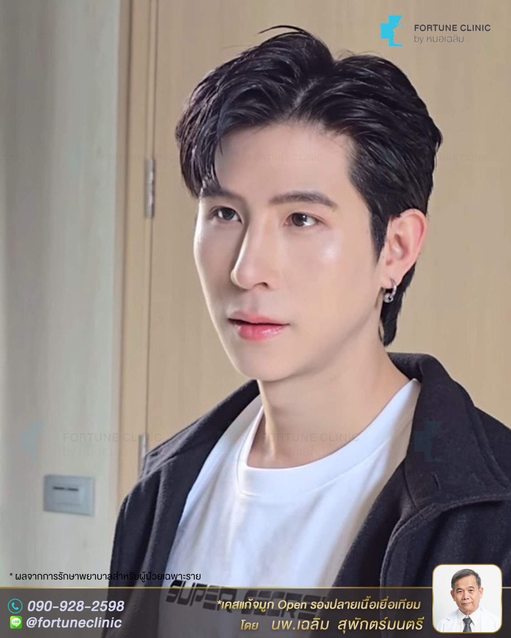 หล่อเป๊ะ คุณปาร์ค ภาณุภัทร นักแสดงจากซีรีส์วาย "Why R U The Series" มาแก้จมูก Open กับหมอเฉลิม ...